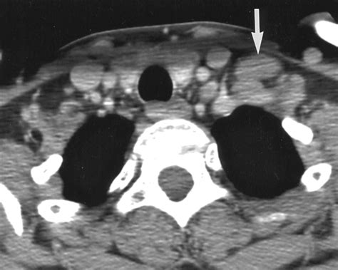 Sonographically Guided Biopsy Of Supraclavicular Lymph Nodes A Simple