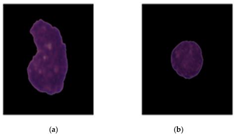 Customized Deep Learning Classifier For Detection Of Acute Lymphoblastic Leukemia Using Blood