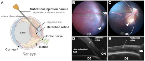 Intraoperative Visualization Of Subretinal Injection And Retinal