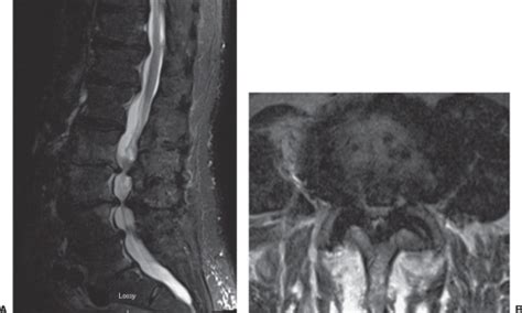 Lumbar Decompression And Instrumented Fusion Techniques Musculoskeletal Key