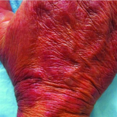A Painful Erythematous Tumid Confluent Papules And Plaques Download Scientific Diagram