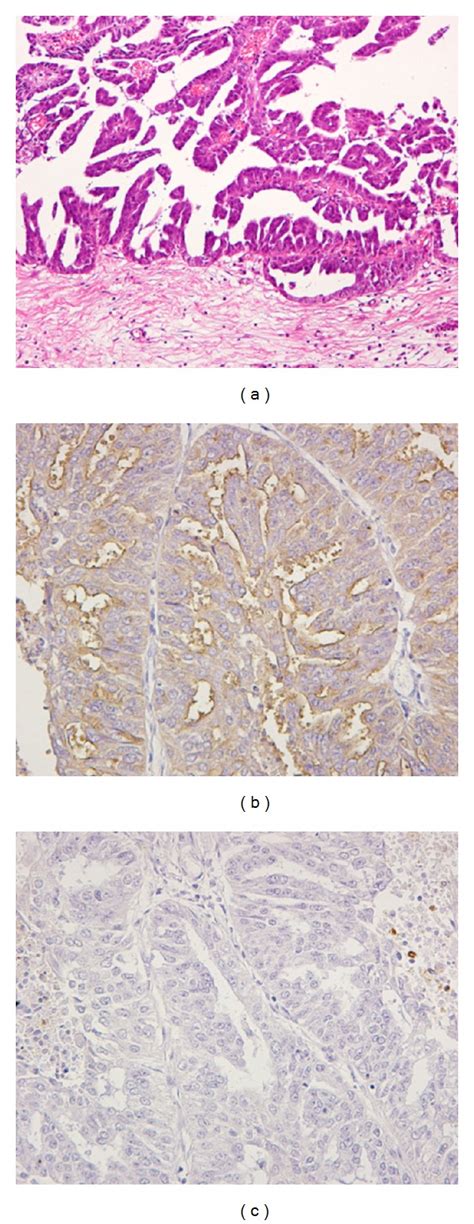 Papillary Serous Carcinoma Of Peritoneum Pscp On Hysterectomy Cancer Download Scientific