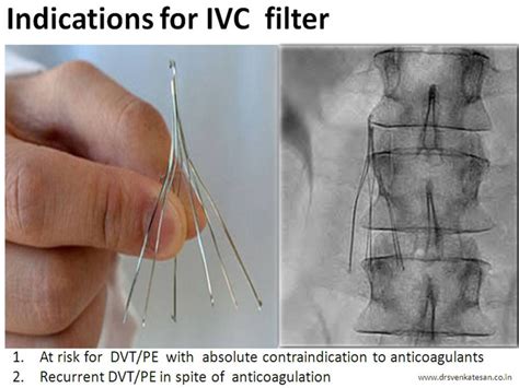 Current Indication For Ivc Filter Dr S Venkatesan Md