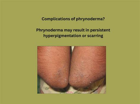 Vitamin A Dermatologypptx Digestive Disorders Diseases And Conditions