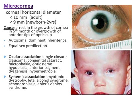 Ophthalmology Anatomy Of Cornea Finalppt