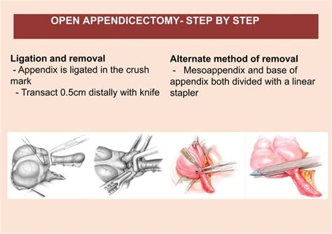 Acute Appendicitis Appendicectomy Open And Laparoscopicpdf Surgery