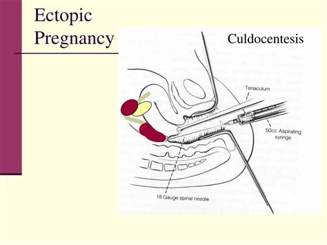 Ppt Ectopic Pregnancy Powerpoint Presentation Free Download Id 6916819