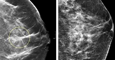 Ai In Healthcare On Linkedin Standalone Ai Excels At Reading Digital Mammograms But How Does