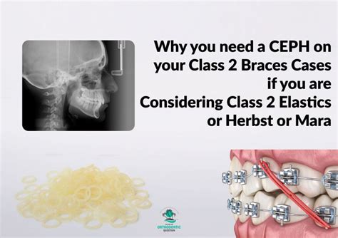 Amanda Wilson Dds Mds On Linkedin Class 2 Elastics How Do They Work Click Link In Bio Or…