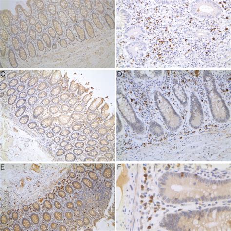 Adenomatous Polyposis Coli APC Immunohistochemistry In The Left Side