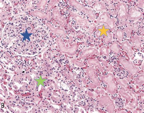 Caseous Necrosis Vs Liquefactive Necrosis