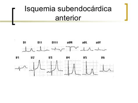 Ekg Isquemialesioneinfartoekg