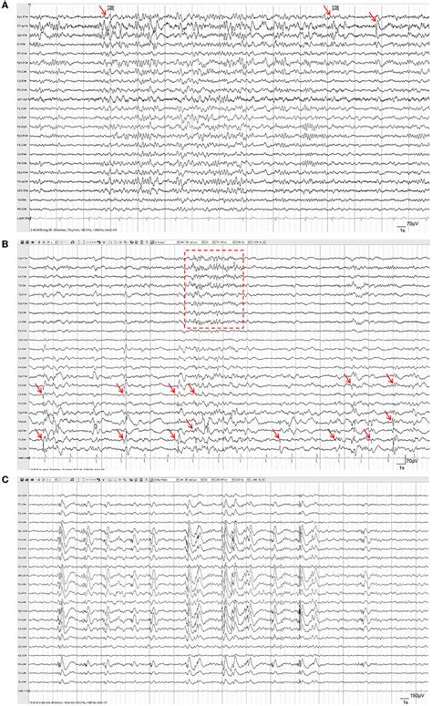FIGURE Representative EEG Of Patients With Refractory Posttraumatic Download Scientific Diagram