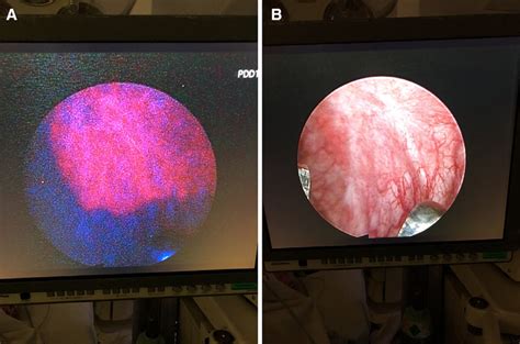 White Light A And Blue Light Photodynamic B Cystoscopy Image Of