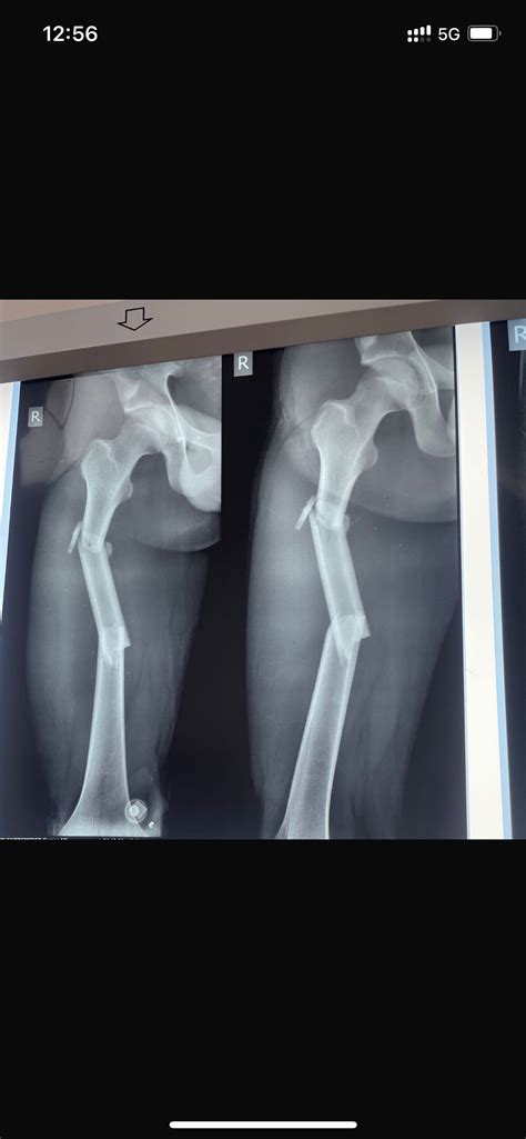 Drikram Ghasura On Linkedin 18 M Segmental Femur Fracture Treated 9 Months Back Came For Routine…