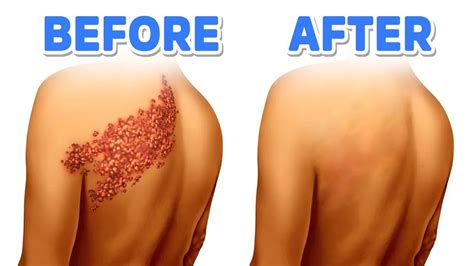 How To Never Get Shingles Again Youtube