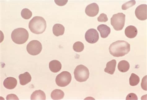 Erythrocytosis Hemolytic Anemias Flashcards Quizlet