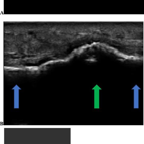 Modified Radiographic Union Scale For The Tibia RUST Score Download Scientific Diagram