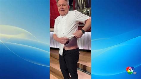 ข่าวเชฟชื่อดัง กอร์ดอน แรมซีย์ โชว์แผลใหญ่อุทาหรณ์หลังจักรยานล้ม