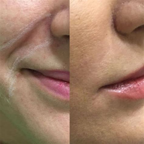 Understanding The Viscosity Of Different Types Of Fillers In Cosmetic