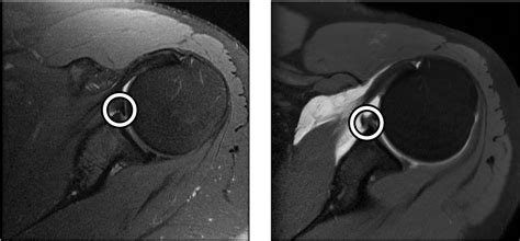 논문 리뷰 Toward Non Invasive Diagnosis Of Bankart Lesions With Deep Learning