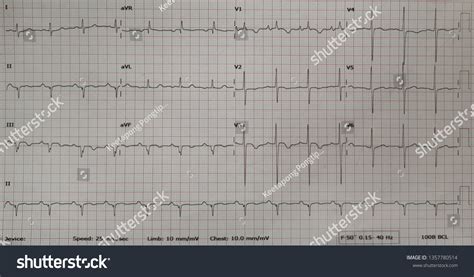 44 Left Axis Deviation Images Stock Photos Vectors Shutterstock