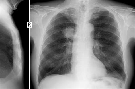 Pd 1pd L1 Inhibitors Co Therapies The Future Of Nsclc Therapy Lies