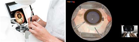 Cataract Surgery Simulation Training Wins Prestigious Award Surgical Science