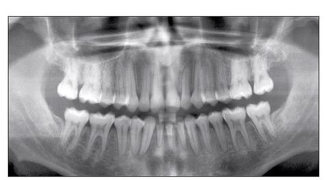 Functional Occlusion And Stability Pocket Dentistry
