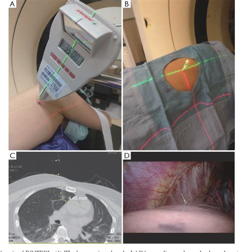 Figure 1 From Preoperative Computed Tomography Guided Pulmonary Nodule Localization Augmented By
