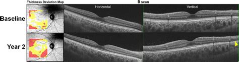 Retinal Thinning Noted On Optical Coherence Tomography Oct Retinal Download Scientific