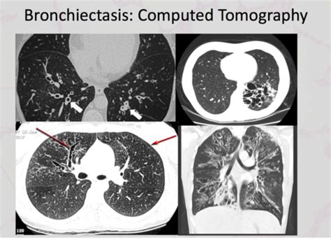 Lecture 39 Bronchiectasis And Ntm Flashcards Quizlet