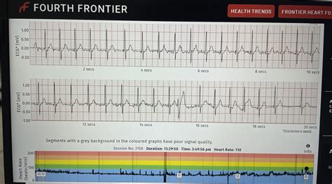Pvcs And Irregular Rhythm When Masturbating Rpvcs Pvcs And Irregular Rhythm When Masturbating Rpvcs