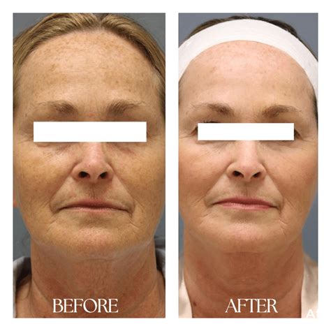 Pixel8 Rf Microneedling New Medical Spa
