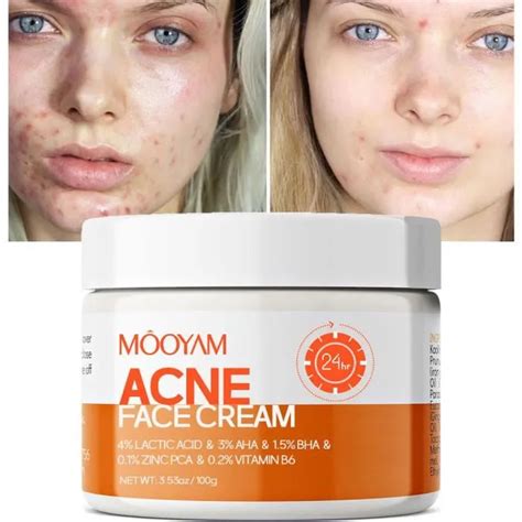 Crème Pour Les Boutons Dacné Quels Médicaments Choisir Contre Les Boutons Dacné Ypdjh