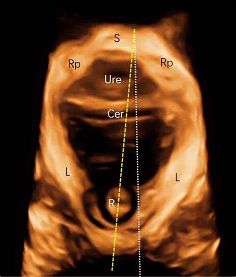 Levator Hiatus Axis Departs From The Pelvic Floor Axis In Women With Download Scientific