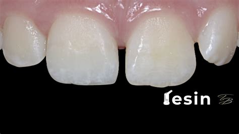 Resin Anterior Foundations 02 02 2025 Dr Tariq Bashir Scottish