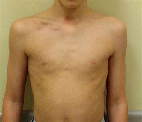 Clavicle Pseudoarthrosis Congenital Hand And Arm Differences Washington University In St Louis