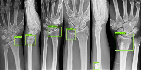 Convolutional Neural Networks For Automated Fracture Detection And