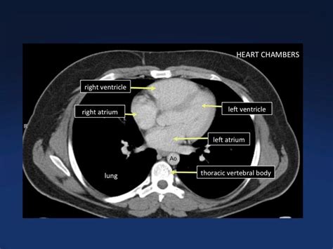 Heart Ct Scan Labeled