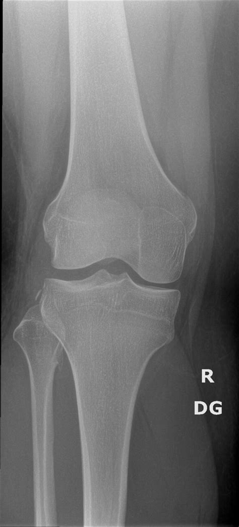 Orthodx Segond Fracture Clinical Advisor