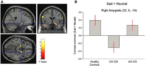 A Statistical Parametric Maps Displaying The Main Effect Of Group For Download Scientific