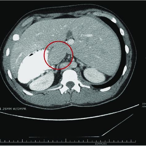 4 1 Abdominal CT Axial View Showing A Mid Pelvic Appendix That Is Download Scientific Diagram