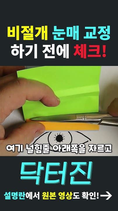 비절개 눈매교정 하기 전에 꼭 체크하세요 Youtube