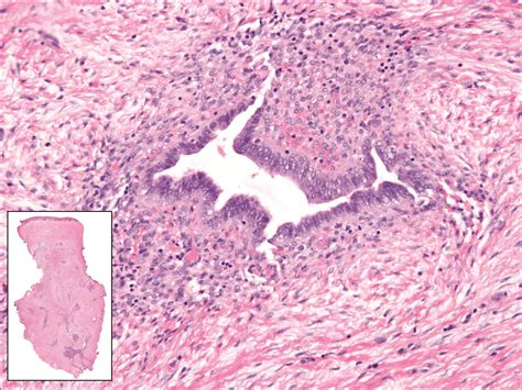 Rapidly Growing Scalp Nodule Mdedge Dermatology