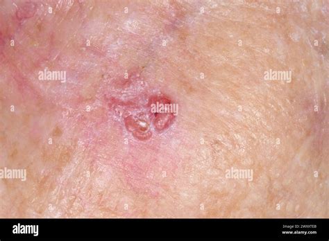 Nodular Basal Cell Carcinoma Bcc On The Cheek Of A 95 Year Old Female