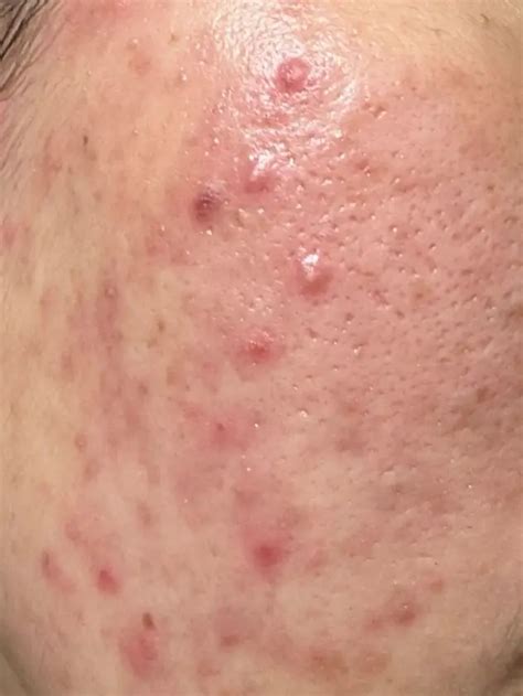 รักษาสิวเองแบบไม่พึ่งคุณหมอฉบับมือใหม่ แกลเลอรีที่โพสต์โดย Fluke Fix Lemon8