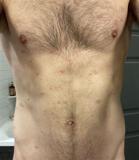 Rash Rdermatology