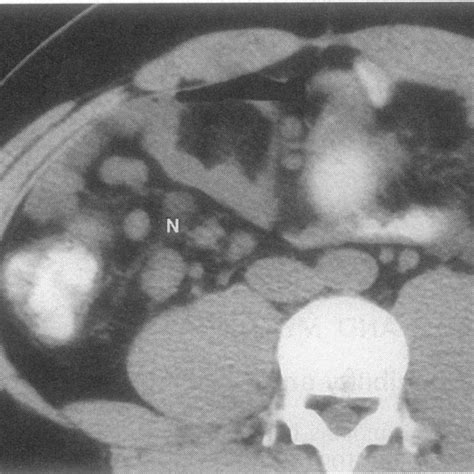 Section Of The Appendix Hyperplasia Of The Lymphatic Tissue Is Evident Download Scientific
