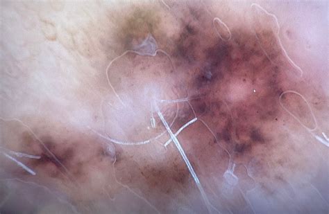 Ben Wiese Primary Care Skin Cancer Physician 🔍 What Is A Nevus With